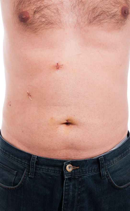How Long Is Stomach Swollen After Laparoscopic Gallbladder Surgery How Long Is Stomach Swollen After Laparoscopic Gallbladder Surgery